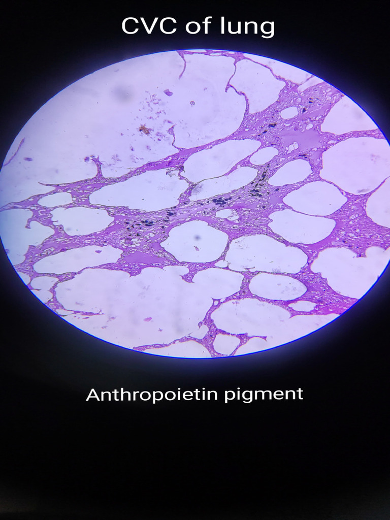 patho slides | PDF | Carcinoma | Causes Of Death