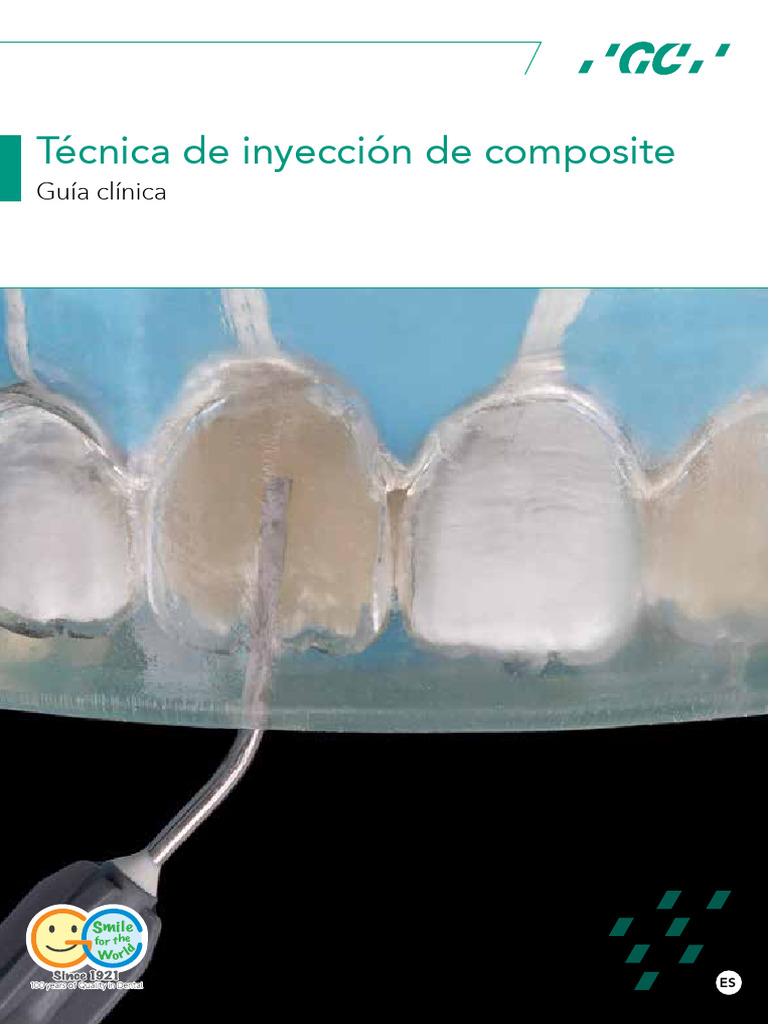Carillas Inyectadas | PDF | Impresión 3d | Compuesto Dental