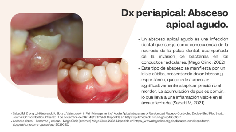 Absceso Apical Agudo | PDF