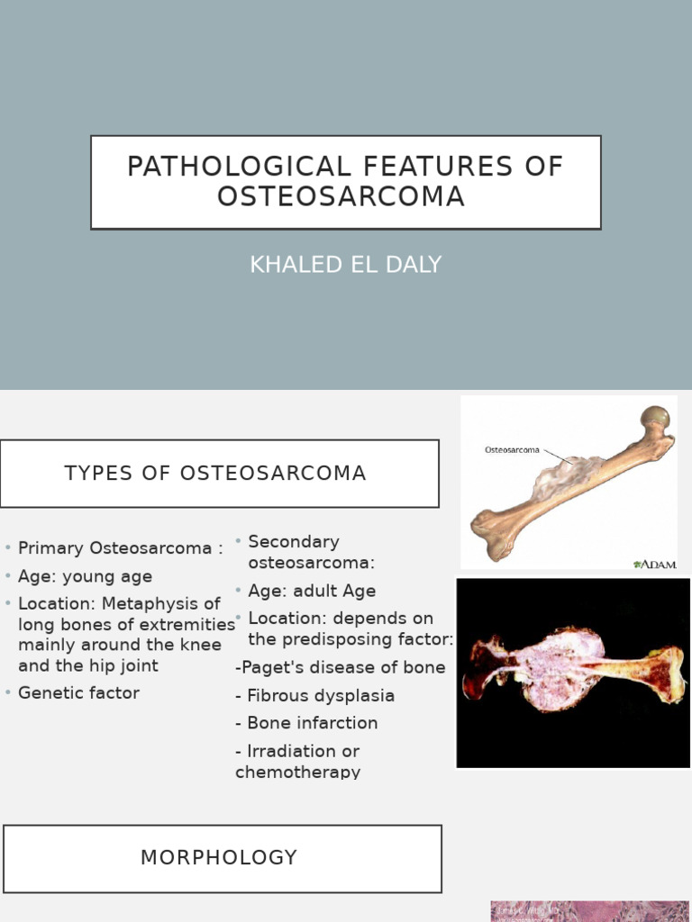Osteosarcoma 2 | PDF