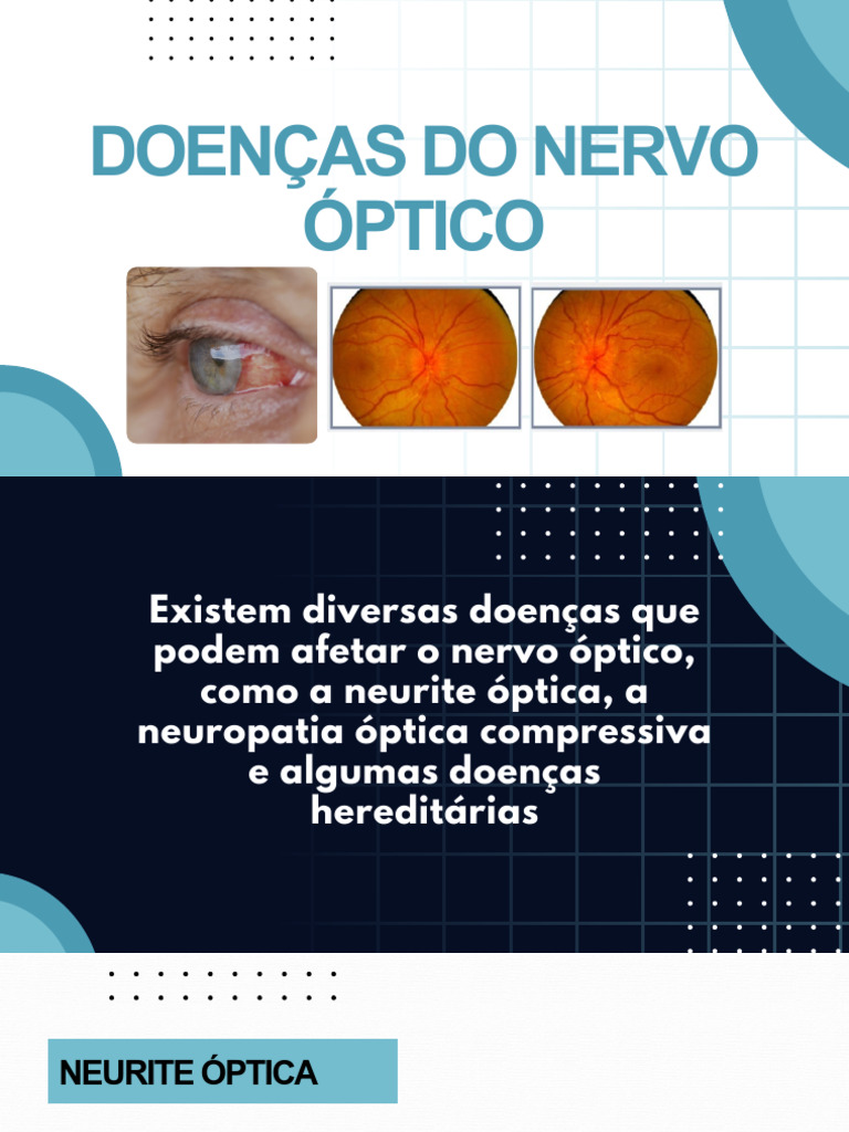 Doenças Do Nervo Óptico | PDF | Deficiência visual | Sistema visual