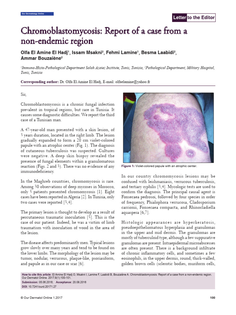 Chromoblastomycosis_Report_of_a_case_from_a_non-en | PDF | Diseases And ...