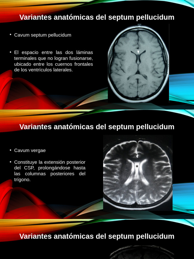 Variantes Anatómicas del Septum | PDF