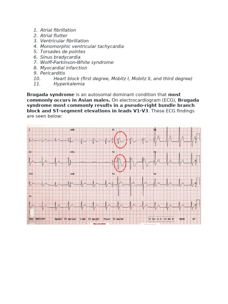 heart | PDF | Electrocardiography | Ventricle (Heart)