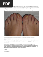 Guía sobre Cromoniquia y Alteraciones Ungueales | PDF | Clavo (anatomía ...