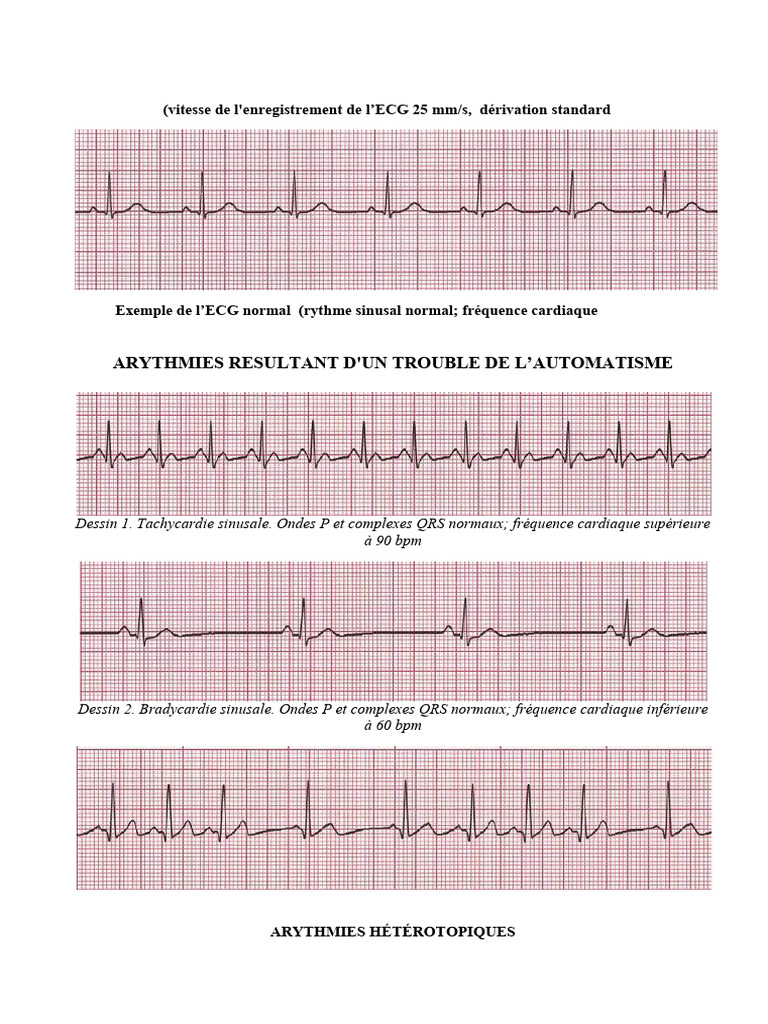 Guide ECG des Arythmies Cardiaques | PDF | Électrocardiographie | Électrophysiologie