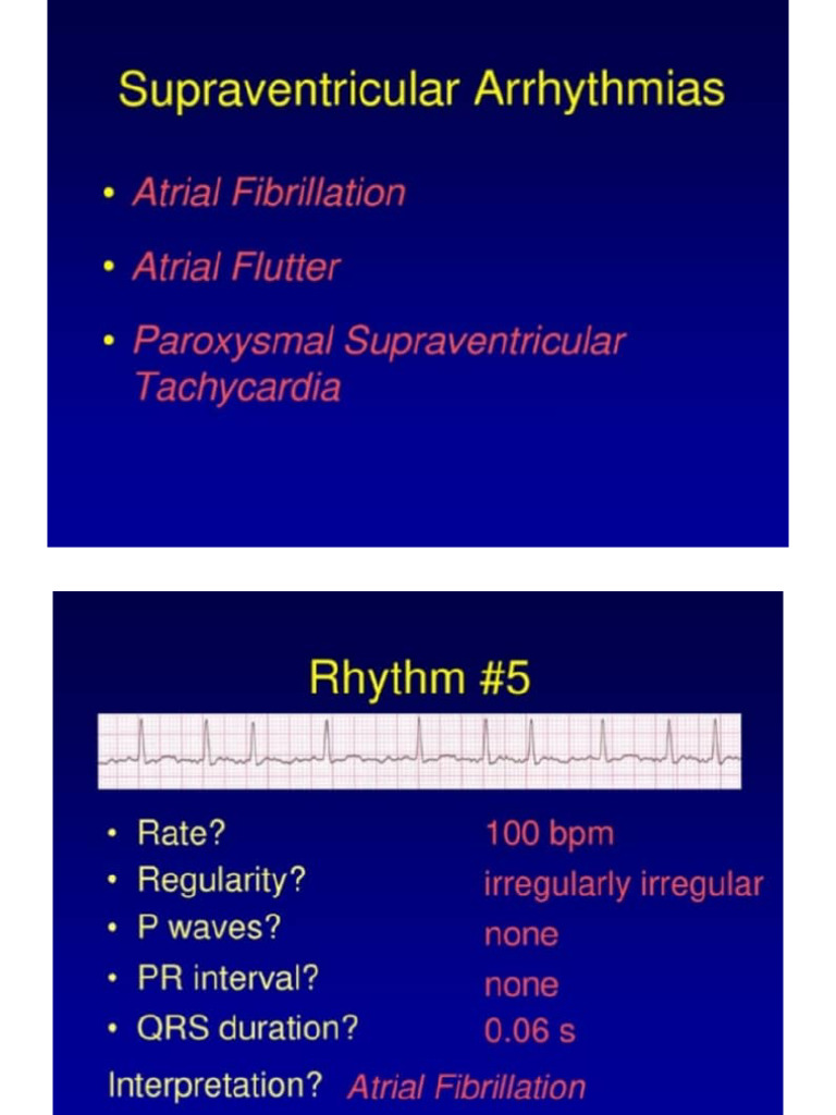 ECG Rhythm Interpretation | PDF