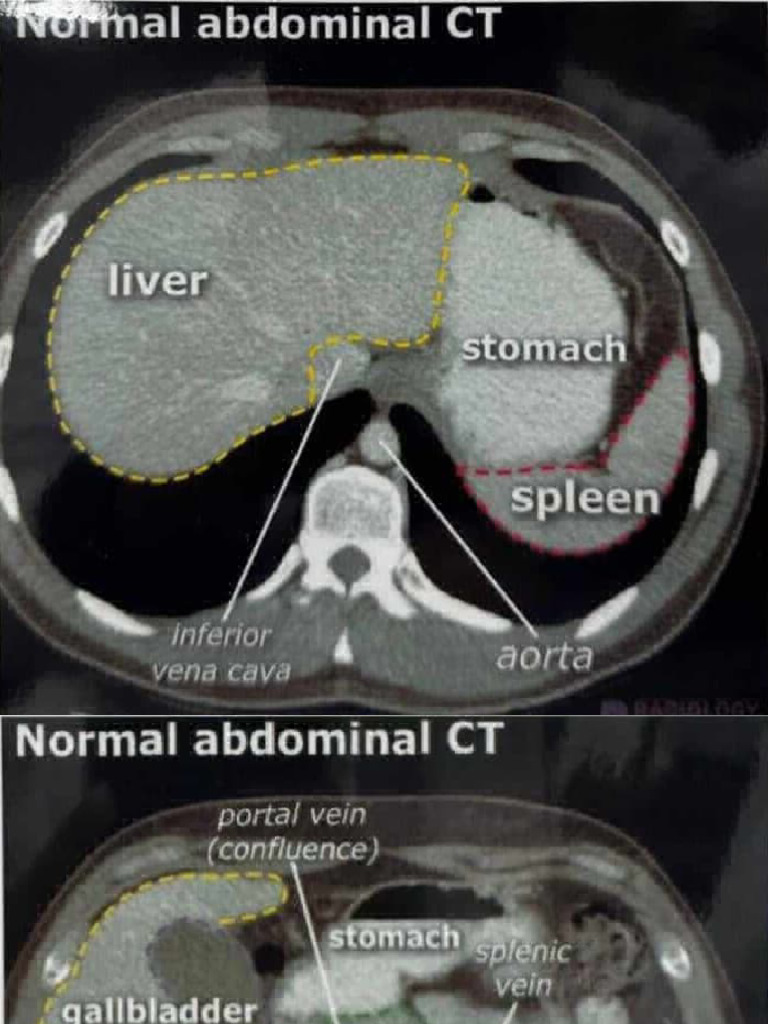 Abdomen CT Scan | PDF