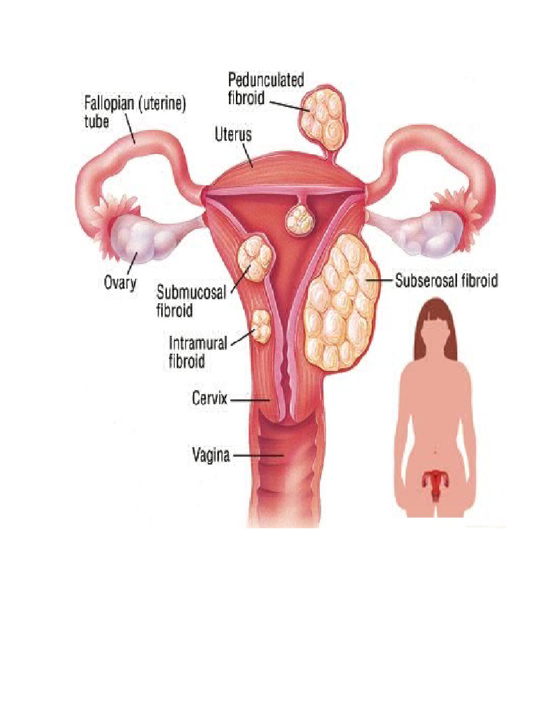 Fibroid | PDF