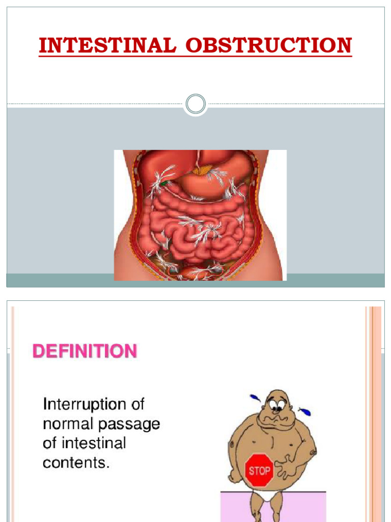 INTESTINAL OBSTRUCTION | PDF | Clinical Medicine | Digestive System