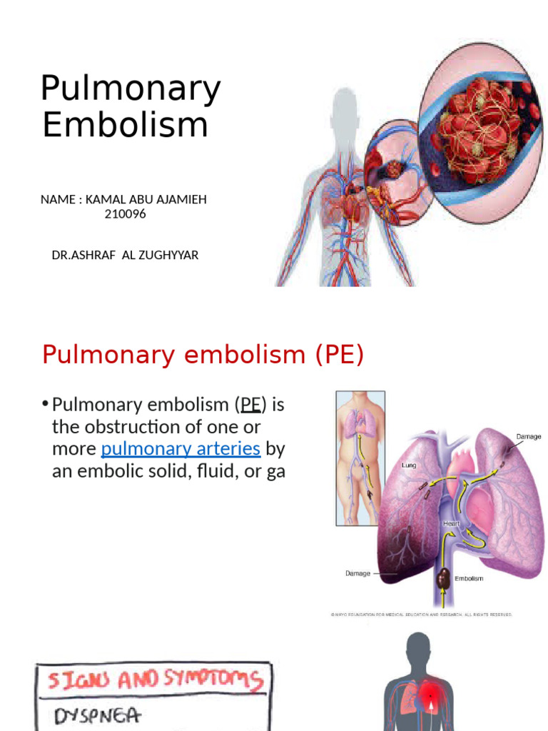 Pulmonary Embolism | PDF