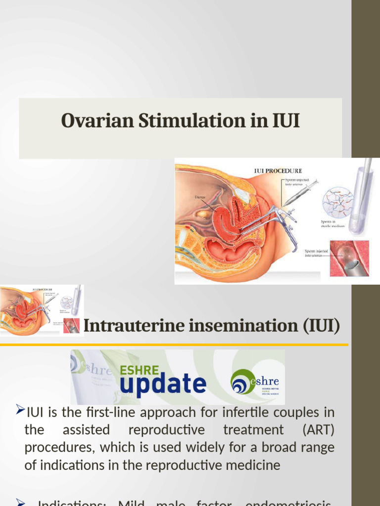Ovarian Stimulation in IUI | PDF | Infertility | Fertility