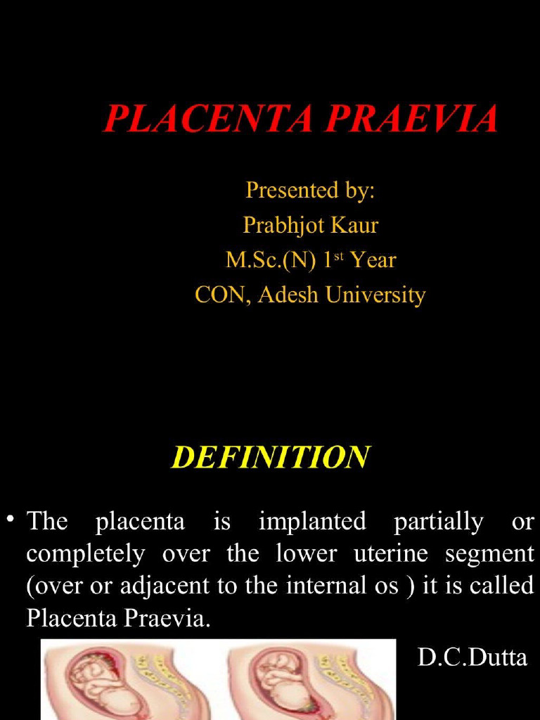 Placenta Previa 78182810 | PDF