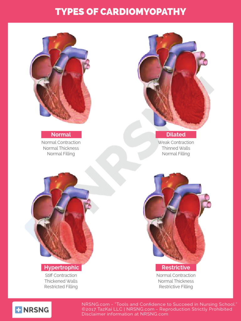 Types Of Cardiomyopathy Explained Pdf