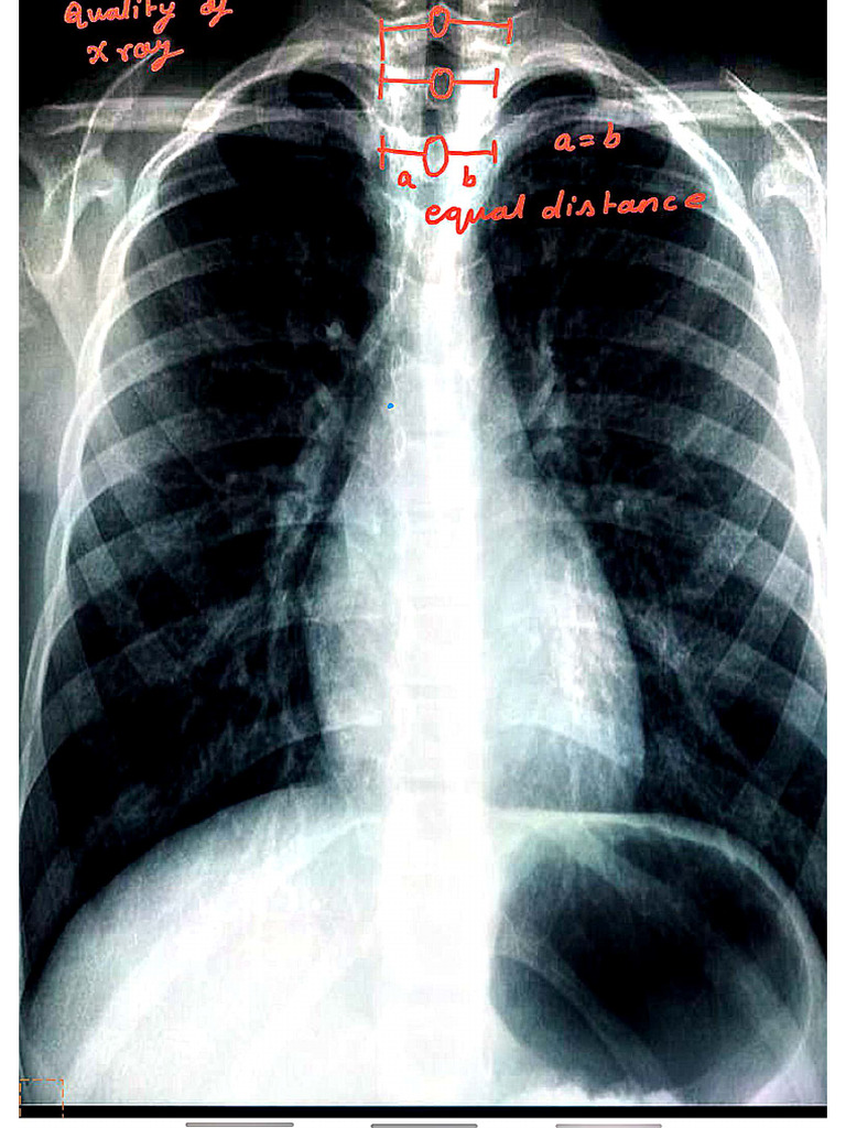Chest X Ray | PDF
