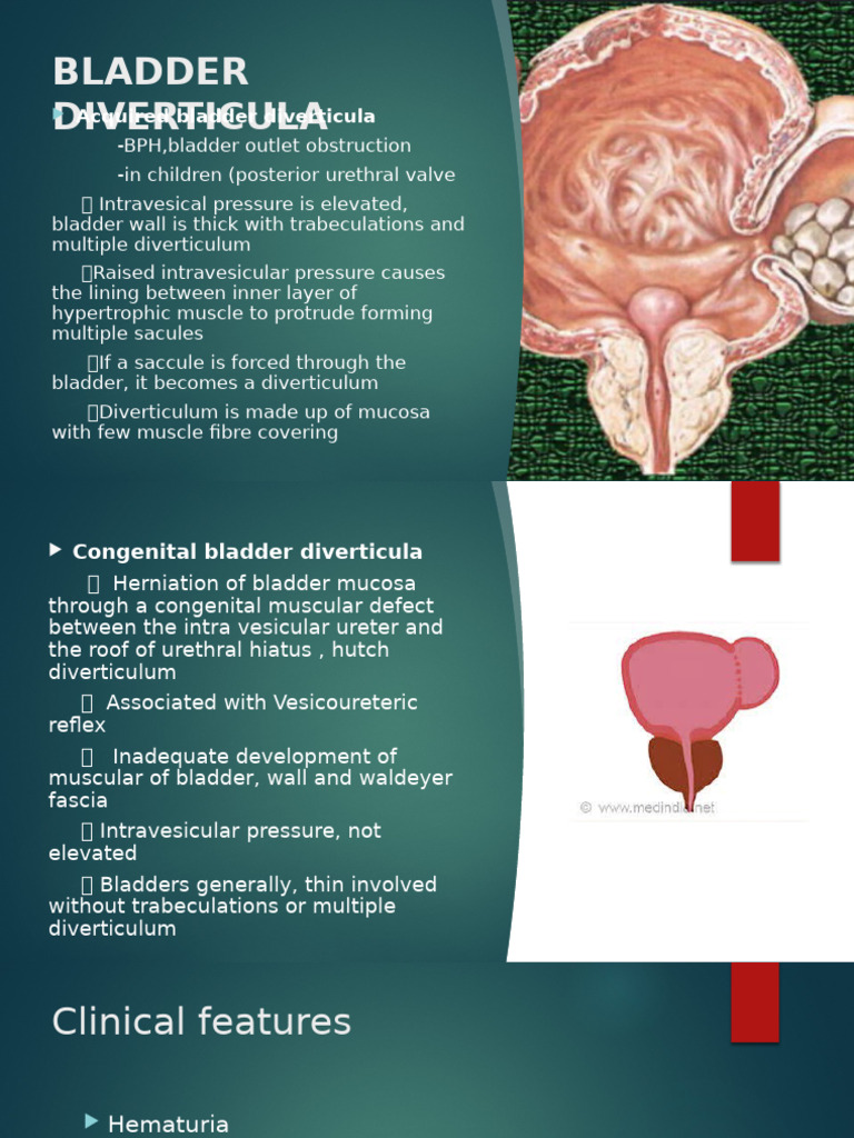 Bladder Diverticula and Related Conditions | PDF | Urinary Incontinence ...