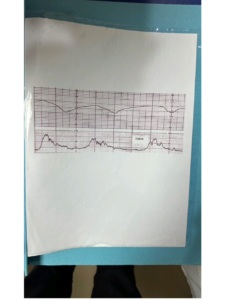 Nst & Partogram | PDF