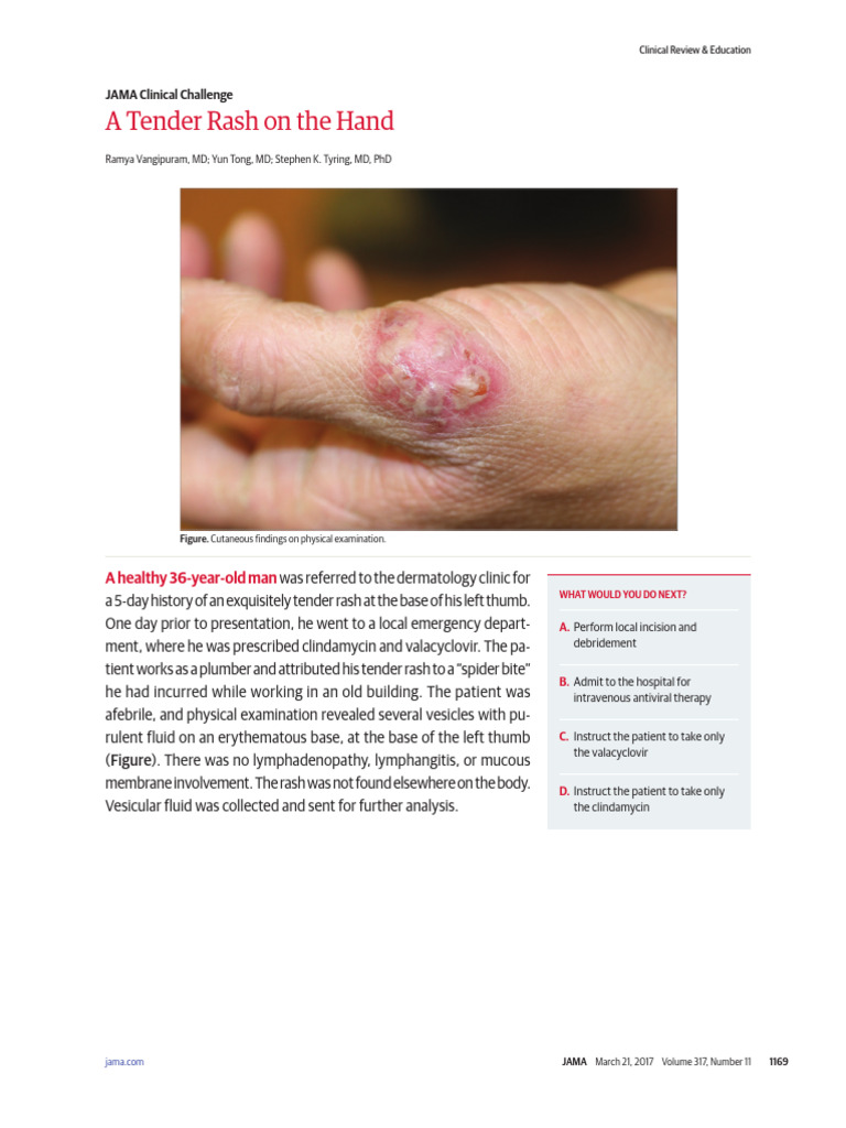 Jama Vangipuram JAMA CASE 2017 | PDF | Viral Diseases | Medical Specialties