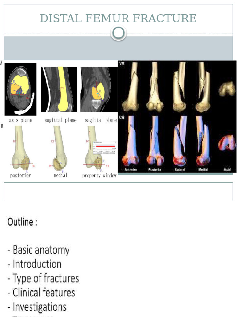 Distal Femur Fracture | PDF