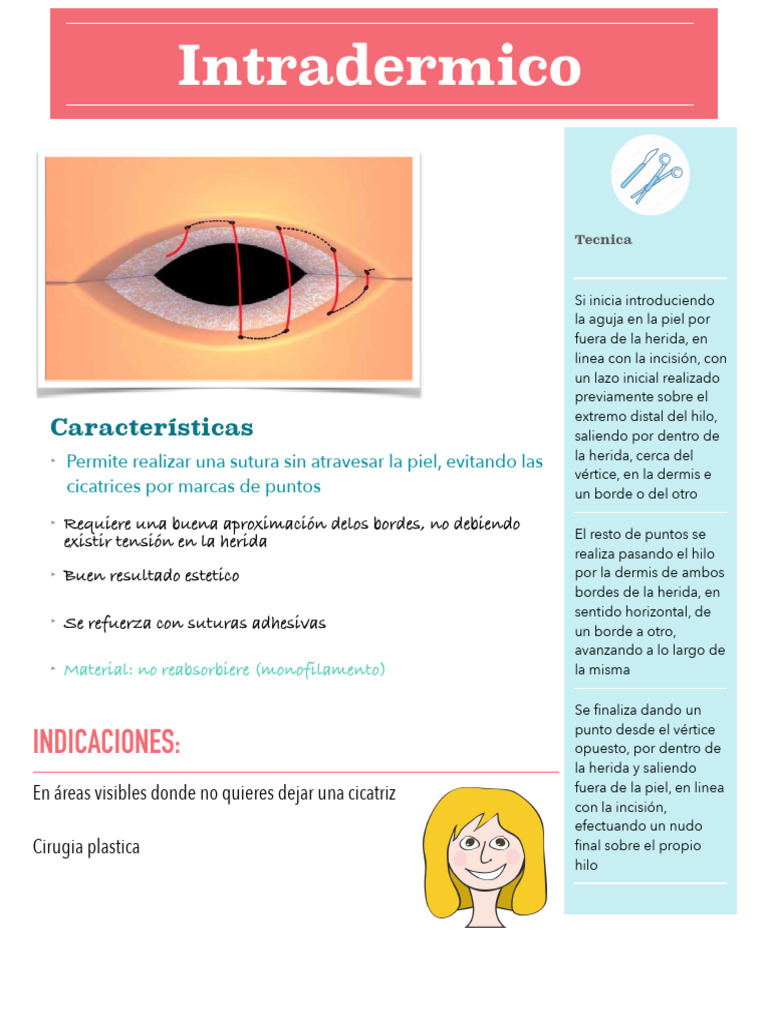 Sutura Intradérmica: Técnica y Aplicaciones | PDF