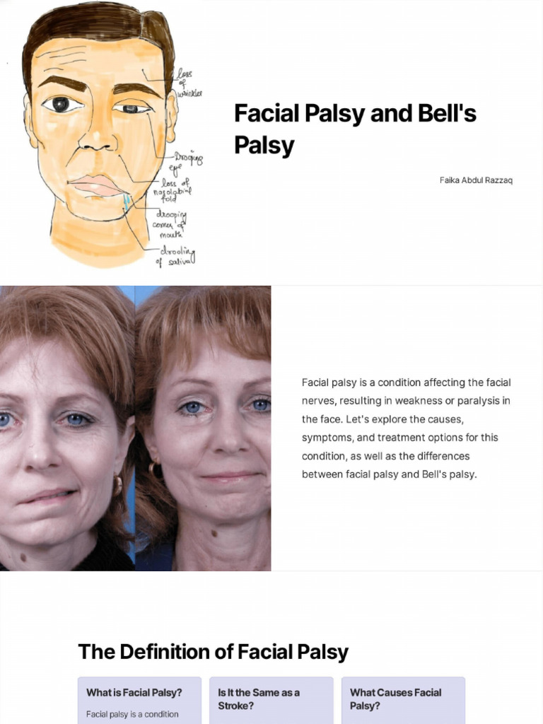Facial Palsy and Bells Palsy | PDF