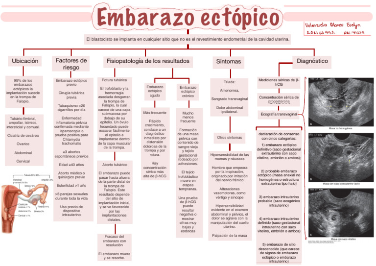 Mapa conceptual Embarazo ectópico | PDF | El embarazo | Obstetricia