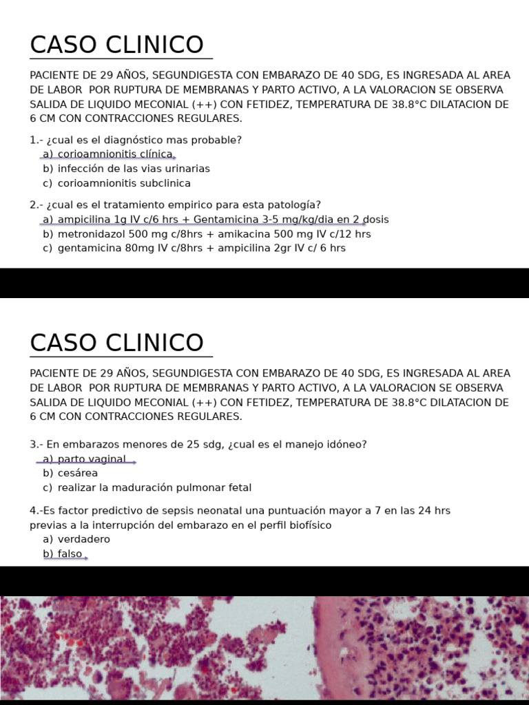 Corioamnionitis GRR | PDF | Parto | El embarazo