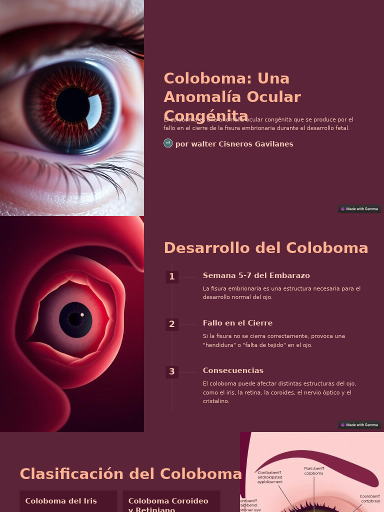 Coloboma-Una-Anomalia-Ocular-Congenita (1) | PDF | Ojo humano ...