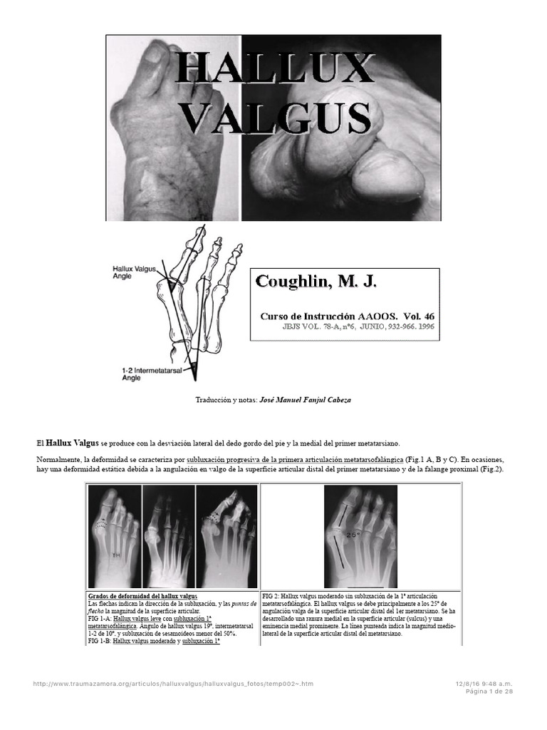 Tratamiento Del Hallux Valgus | PDF | Dedo del pie | Sistema esquelético
