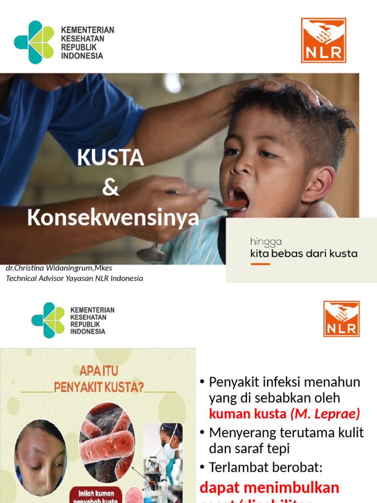 Penyakit Kusta & Konsekwensinya | PDF