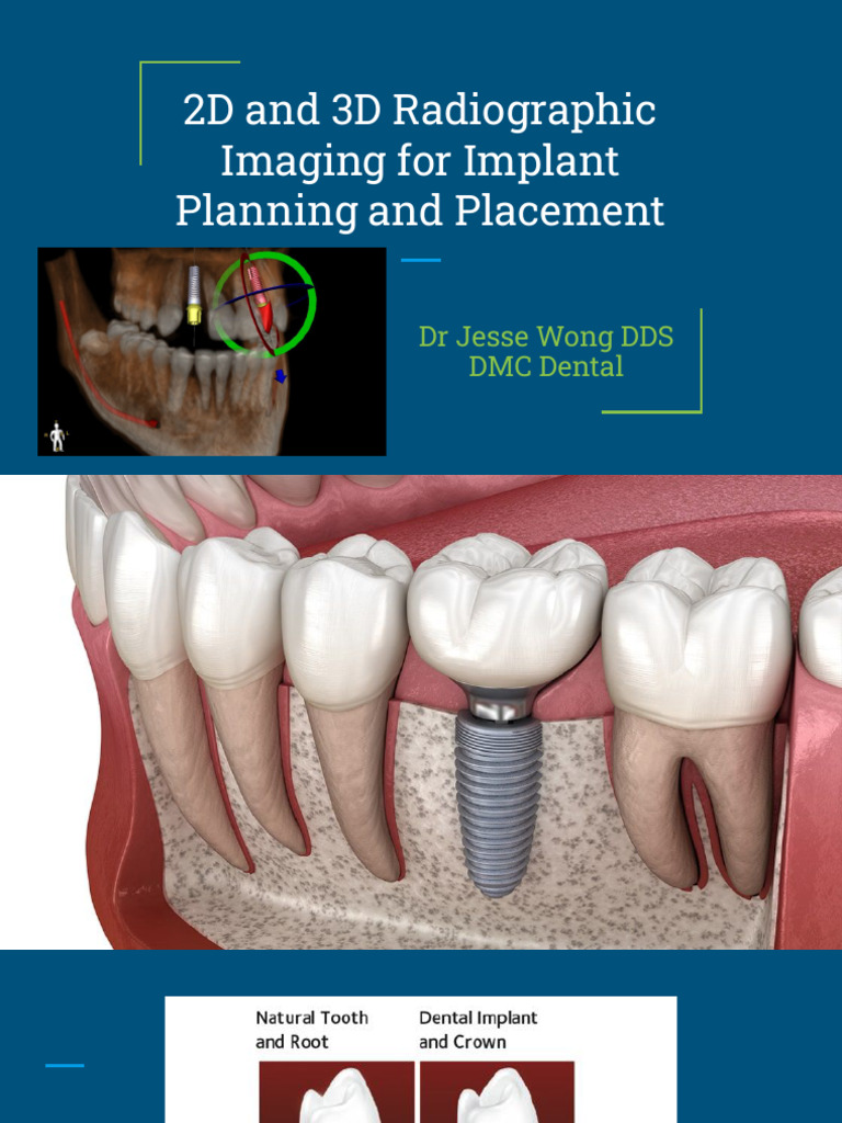 2D and 3D Radiographic Imaging For Implant Planning and Placement | PDF ...