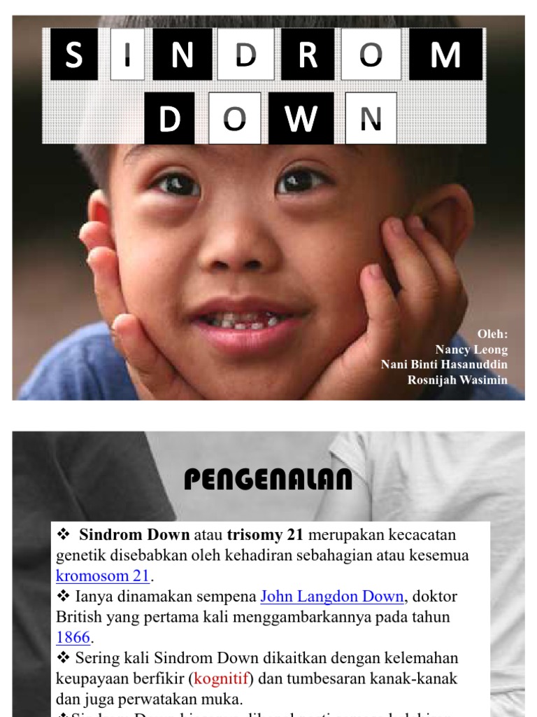 Sindrom Down | PDF