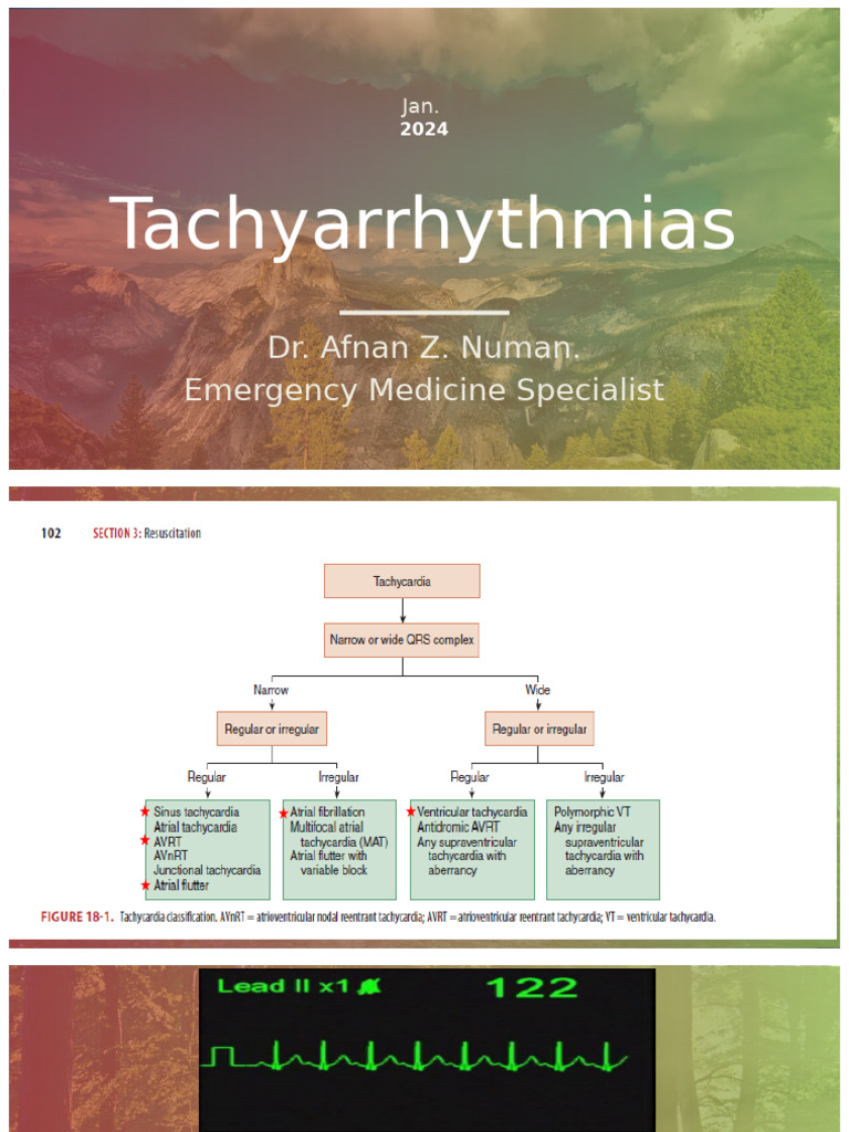 Tachyarrhythmias For Post Graduate | PDF | Heart | Cardiac Arrhythmia