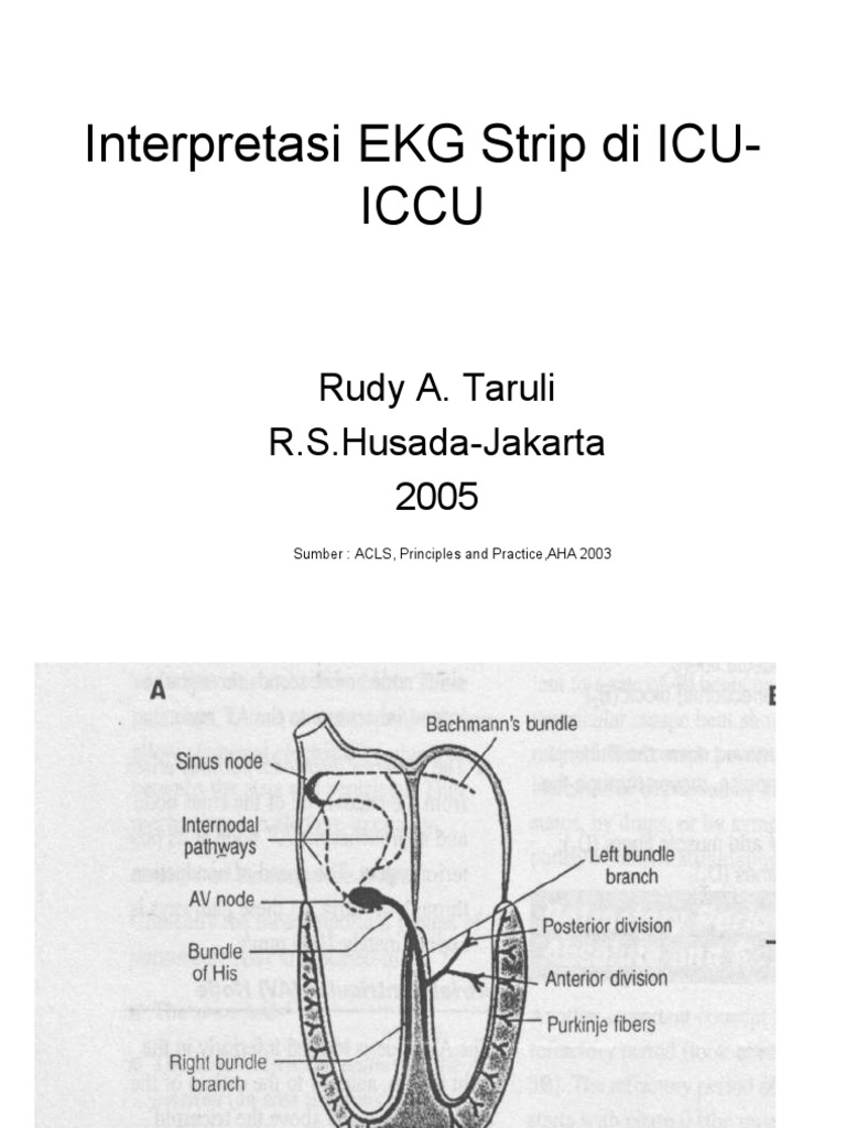 Interpretasi EKG Strip Di ICU-Iccu: Rudy A. Taruli R.S.Husada-Jakarta ...