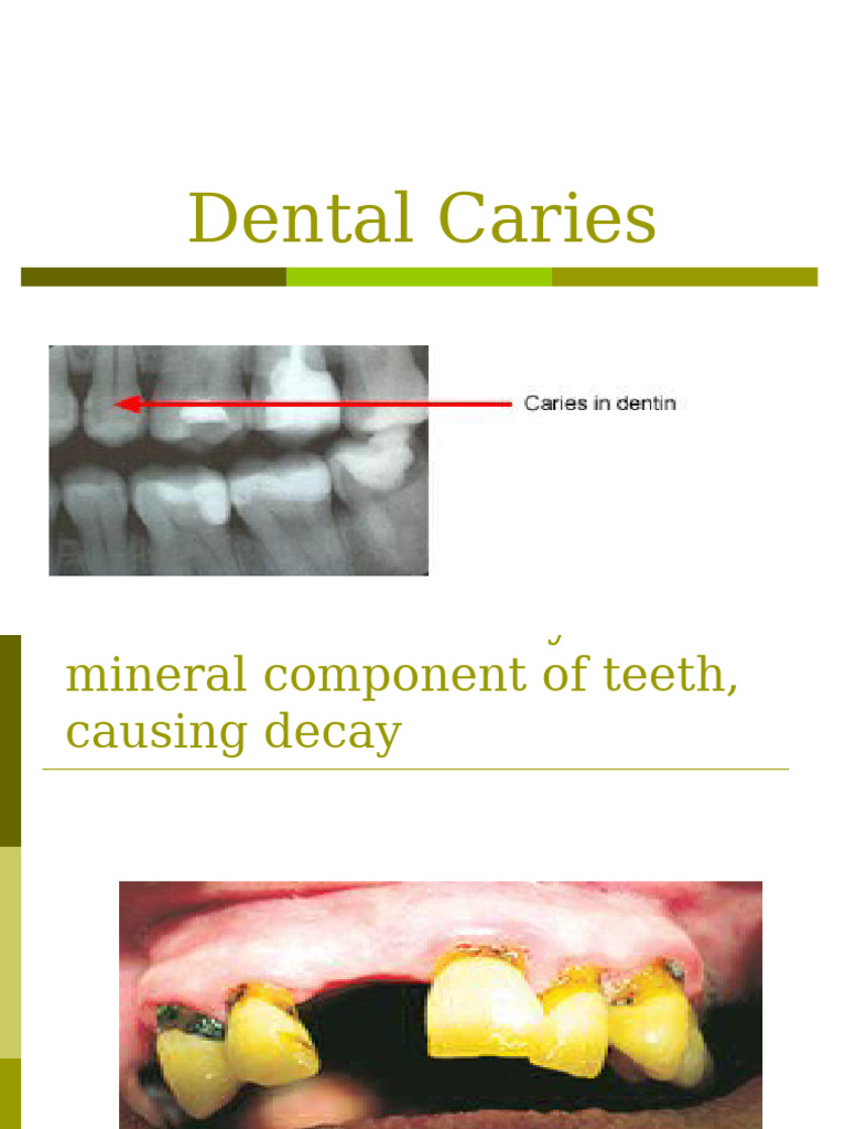 Dental Caries | PDF | Human Tooth | Candidiasis
