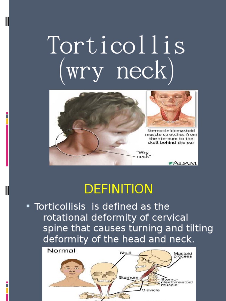 Torticollis Wry Neck | PDF