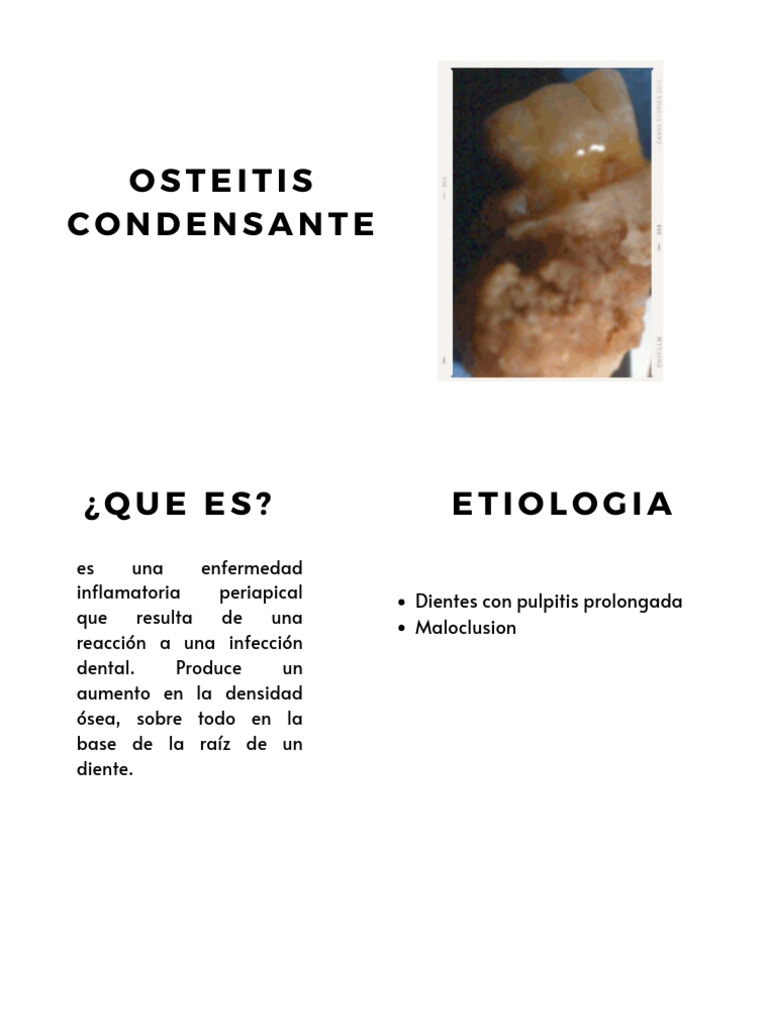 Osteítis Condensante: Guía Clínica | PDF | Hueso | Diente
