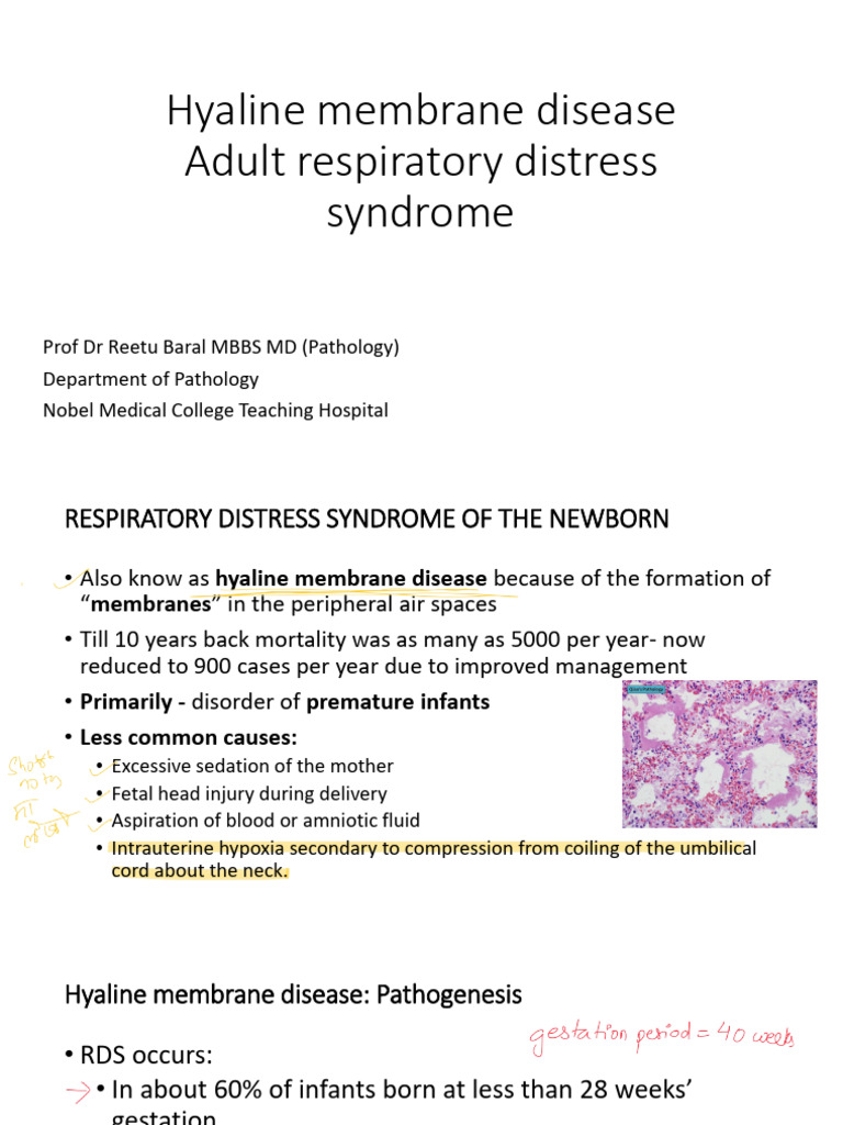 Understanding Hyaline Membrane Disease | PDF | Lung | Respiratory System