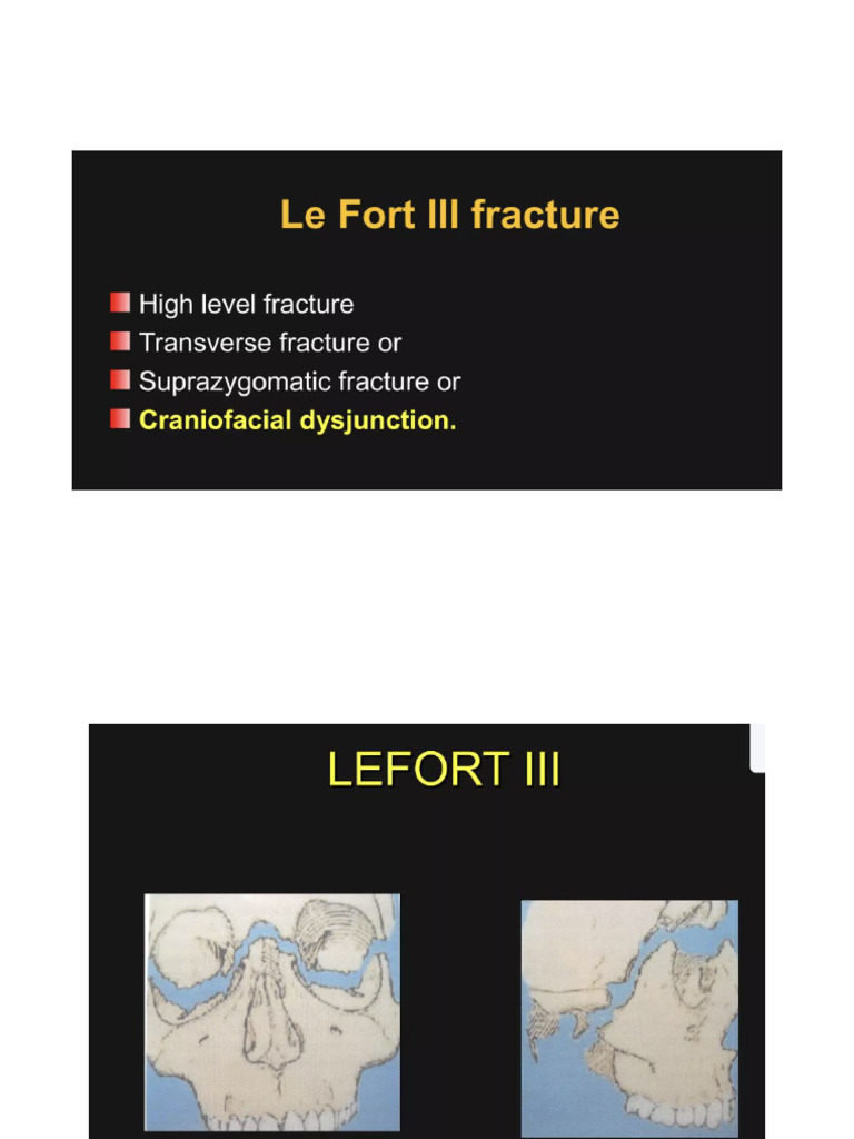 Lefort III | PDF