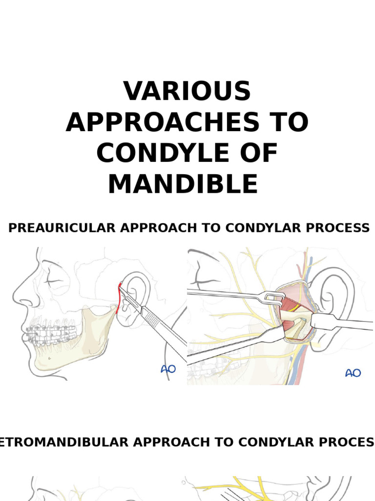 APPROACHES TO CONDYLE OF MANDIBLE | PDF