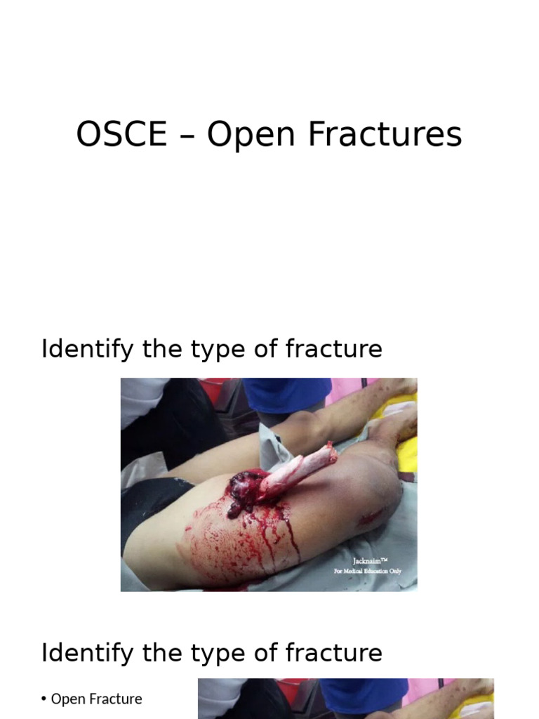 Open Fractures: A Clinical Guide | PDF