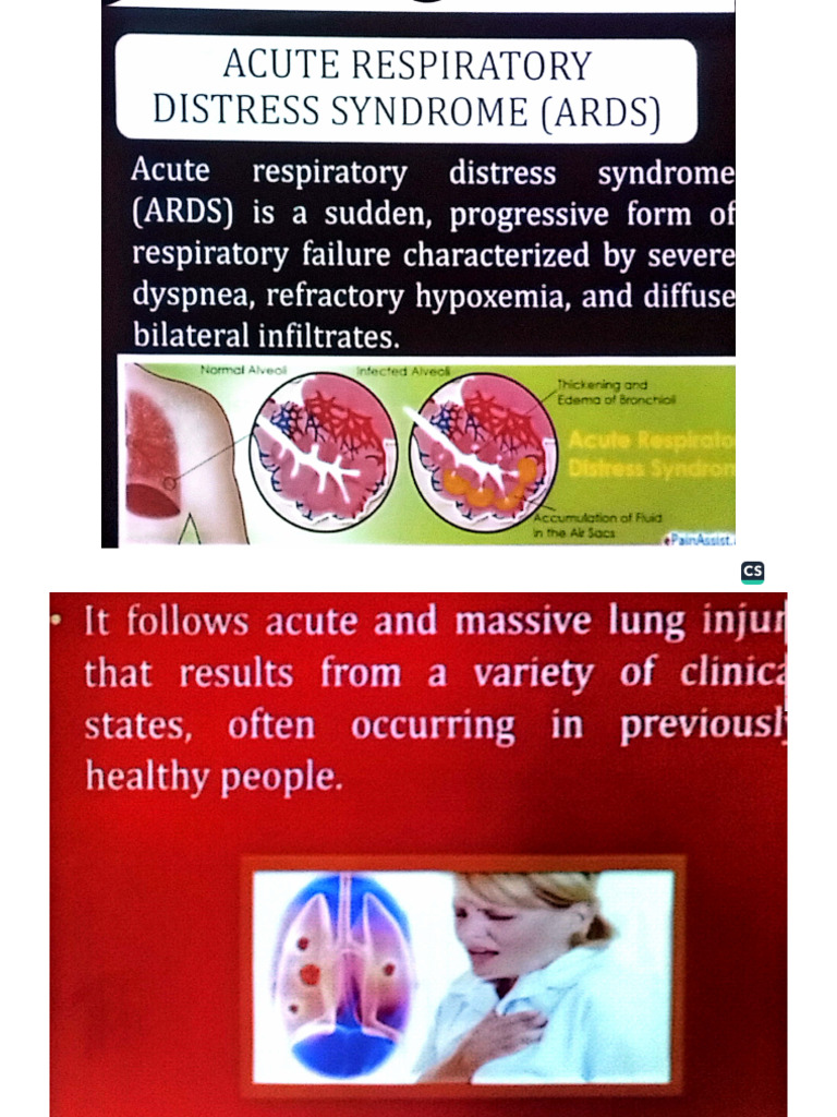ARDS Pathology | PDF