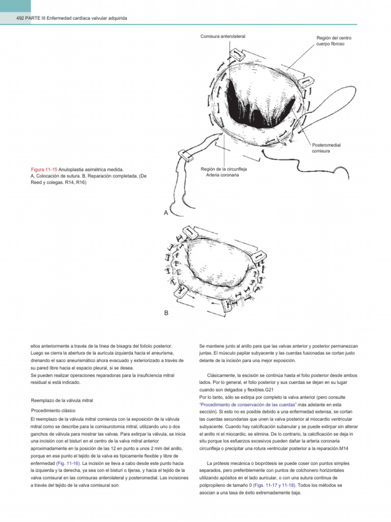 Anuloplastia y Reemplazo Mitral | PDF | Corazón | Sistema cardiovascular
