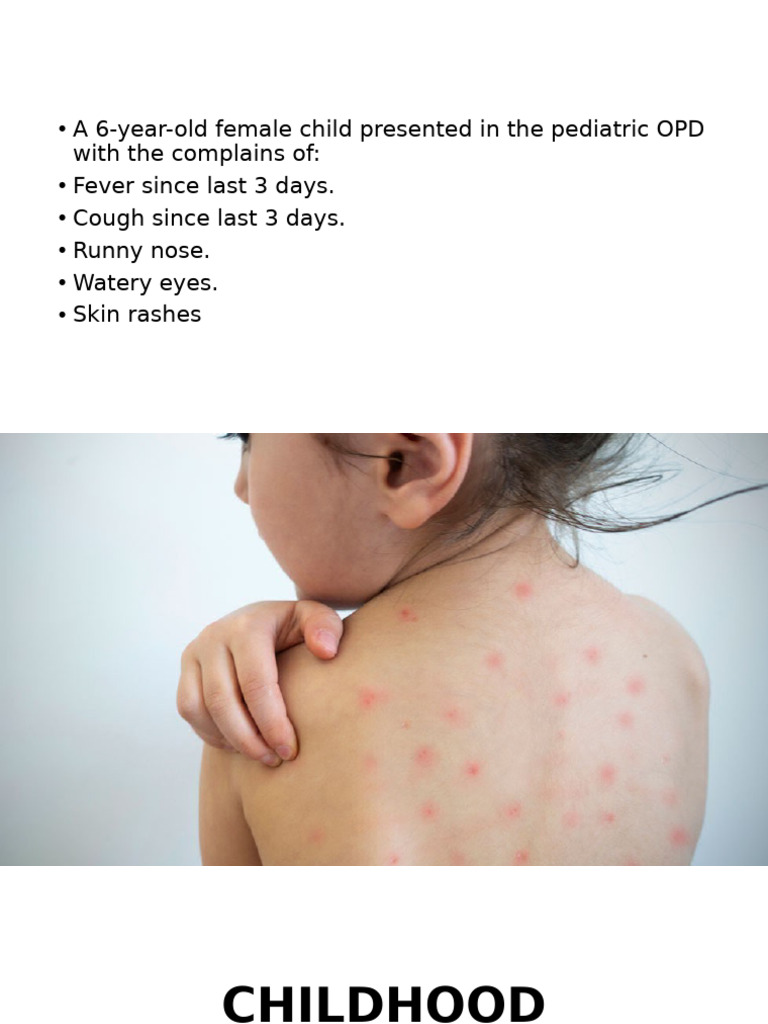 Childhood Viruses. Final | PDF | Measles | Virus