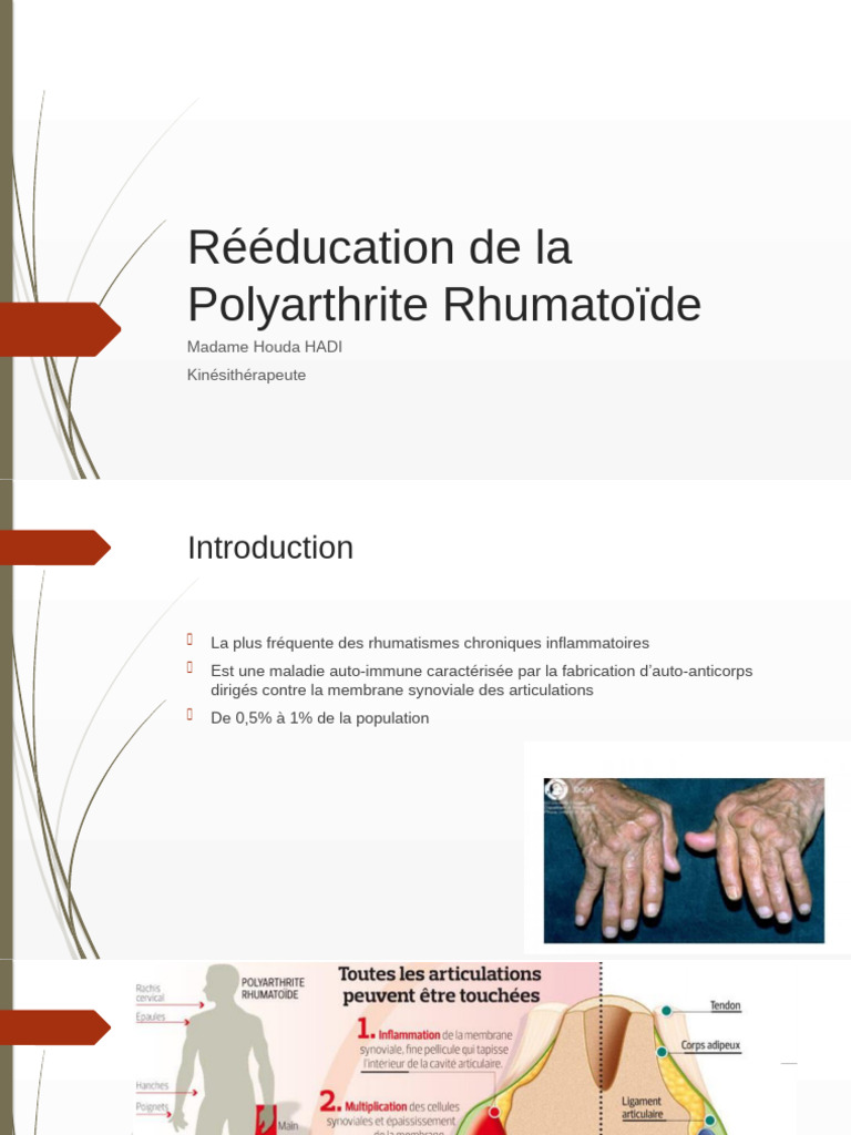 Rééducation de la Polyarthrite Rhumatoïde | PDF | Polyarthrite ...