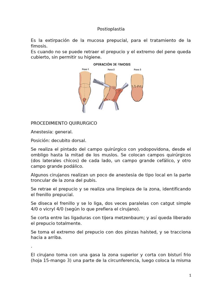 Postioplastia | PDF