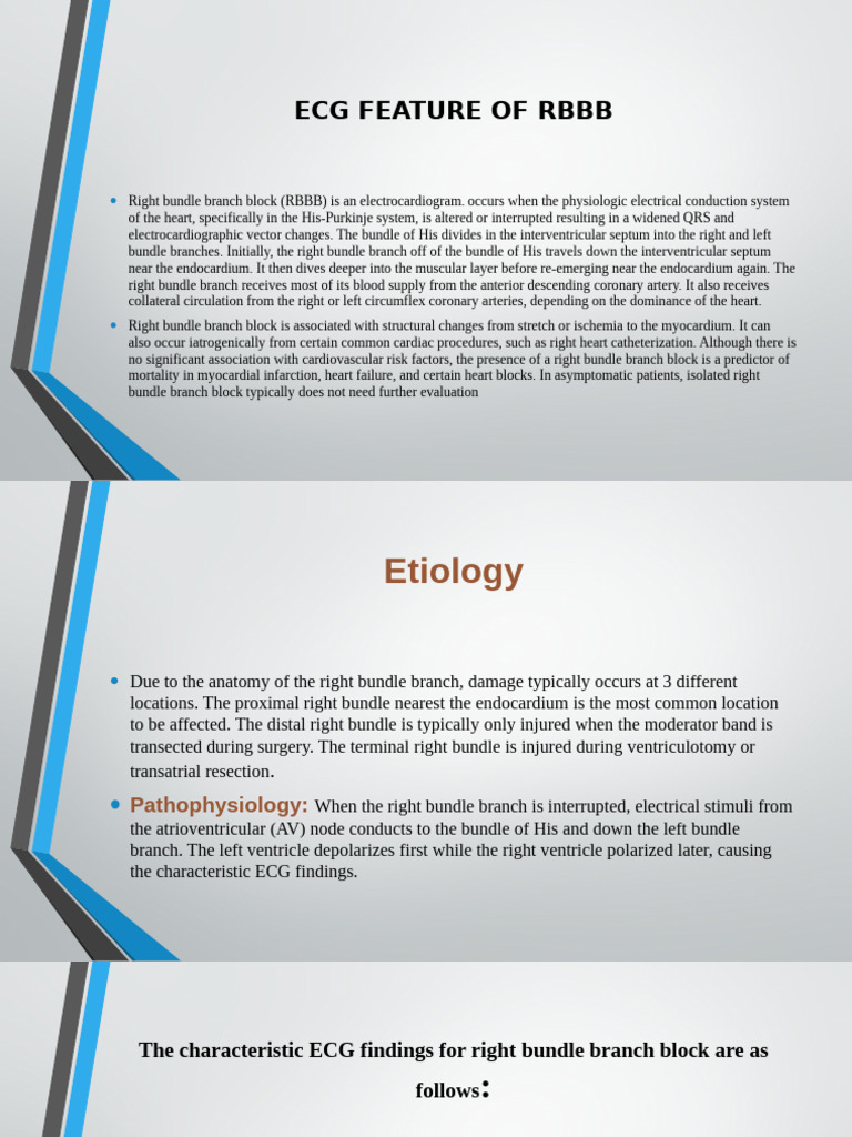 Ecg Feature of RBBB | PDF | Electrocardiography | Heart