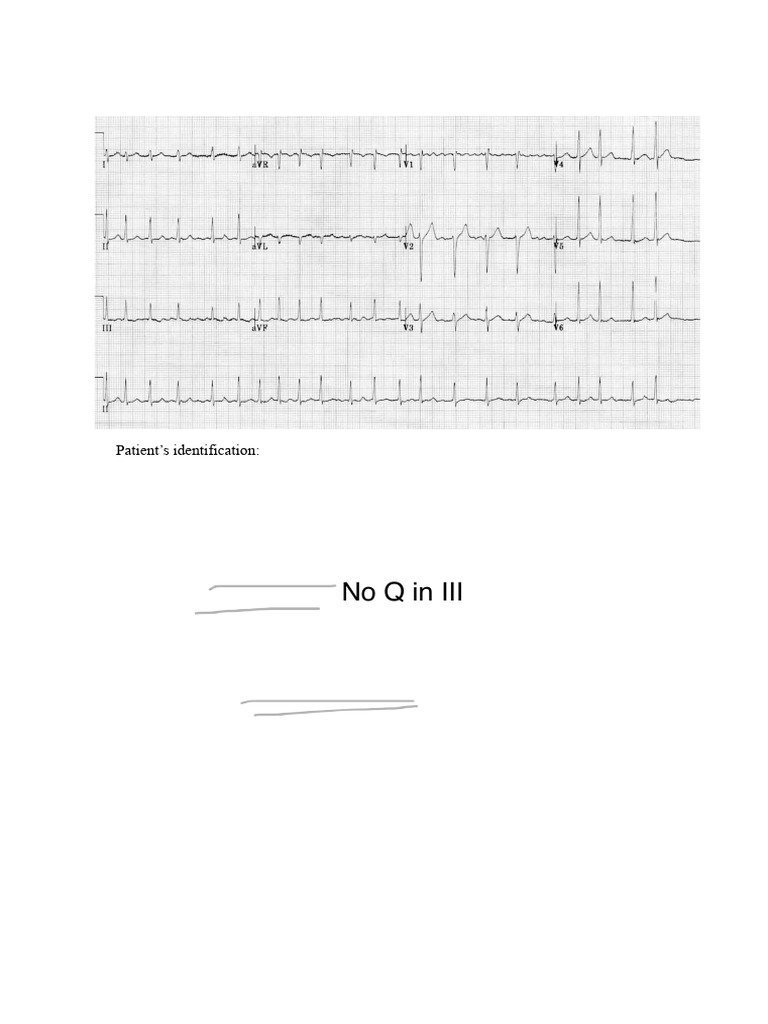 ECG Tutorial 2 (Whole Group 2) | PDF | Electrocardiography | Heart