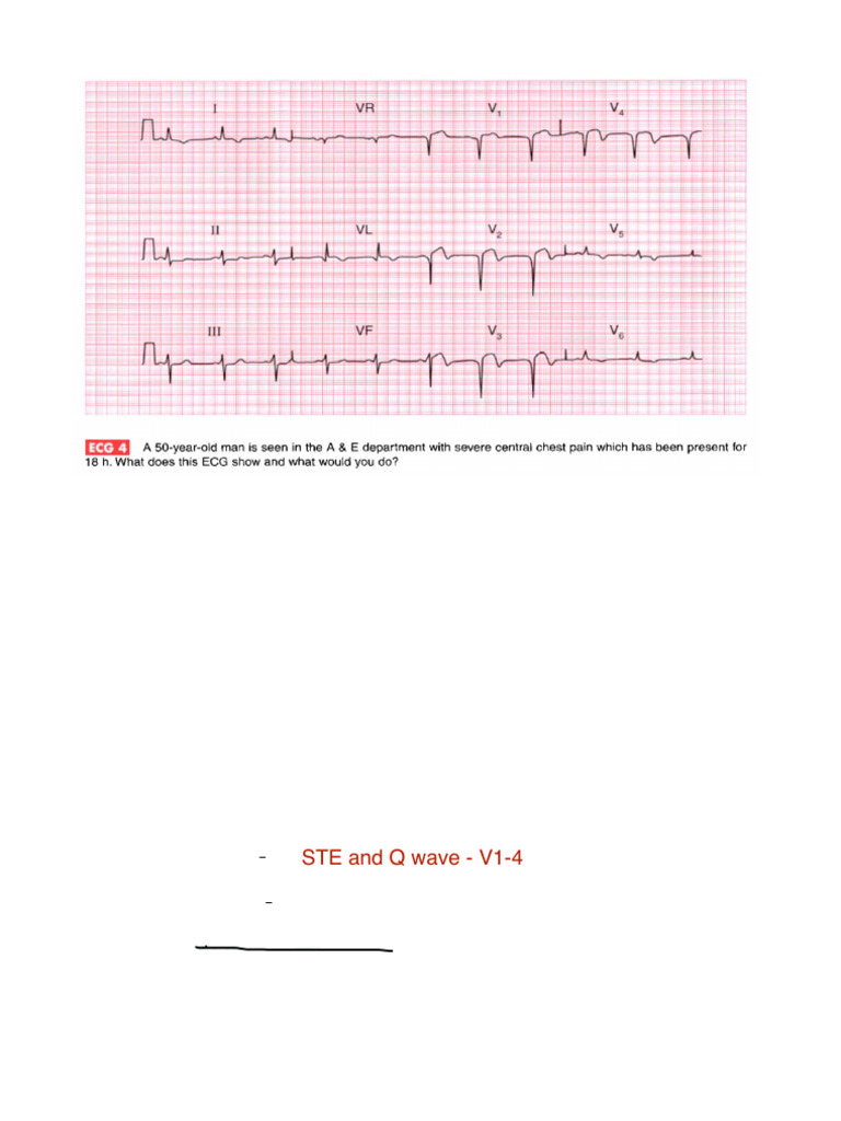 ECG Tutorial 1 (Whole Group 2) | PDF | Electrocardiography | Medical ...