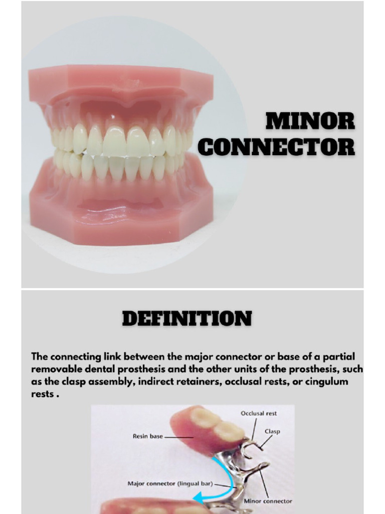 minor connector prostho | PDF